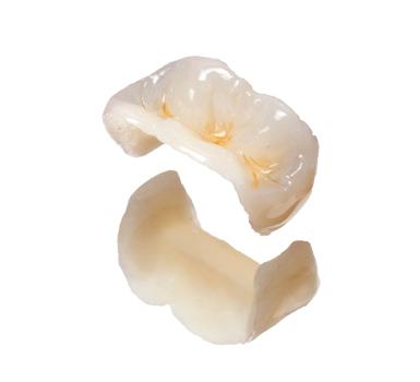 Inlay Onlay composite bio-compatible pour restauration partielle